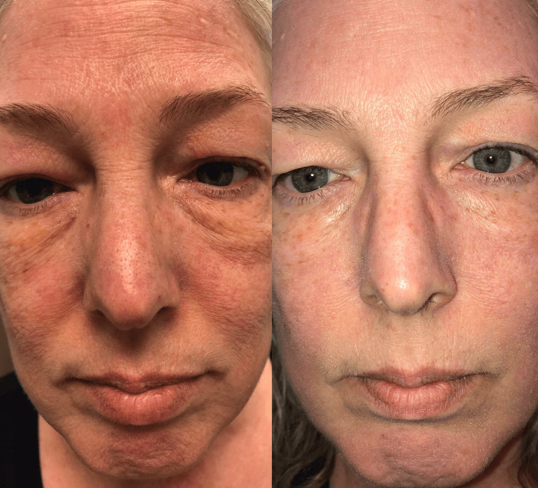 Forever Young BBL Treatment In Erie, PA - Glow Laser Beauty